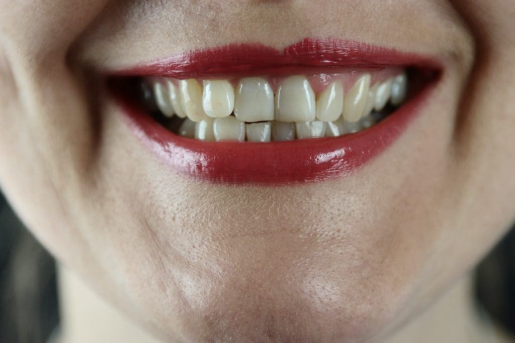 Whitening a Dead Tooth: What You Should Know
